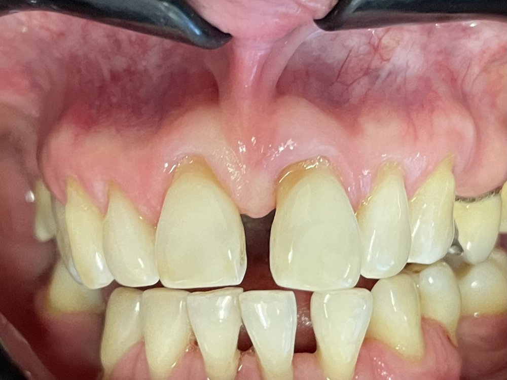 Before & After Photos | Butterfly Dental Care