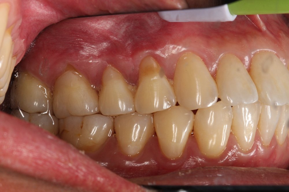 Before & After Photos | Butterfly Dental Care
